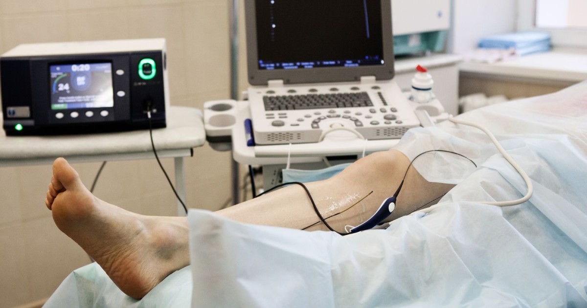 [2026] Laser Varicose Vein: duration, cost and step by step