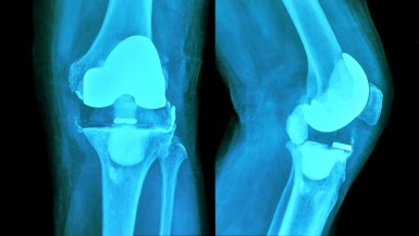 Knee dislocation: causes, symptoms and treatment