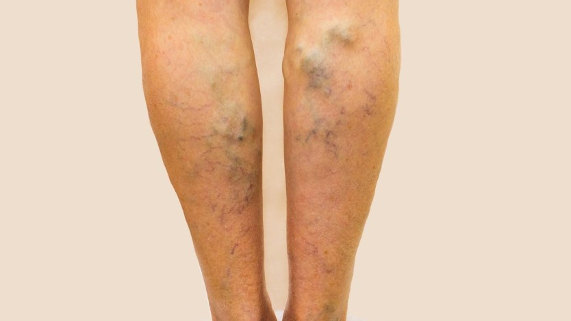 [2026] Varicose vein surgery: duration, cost and step by step